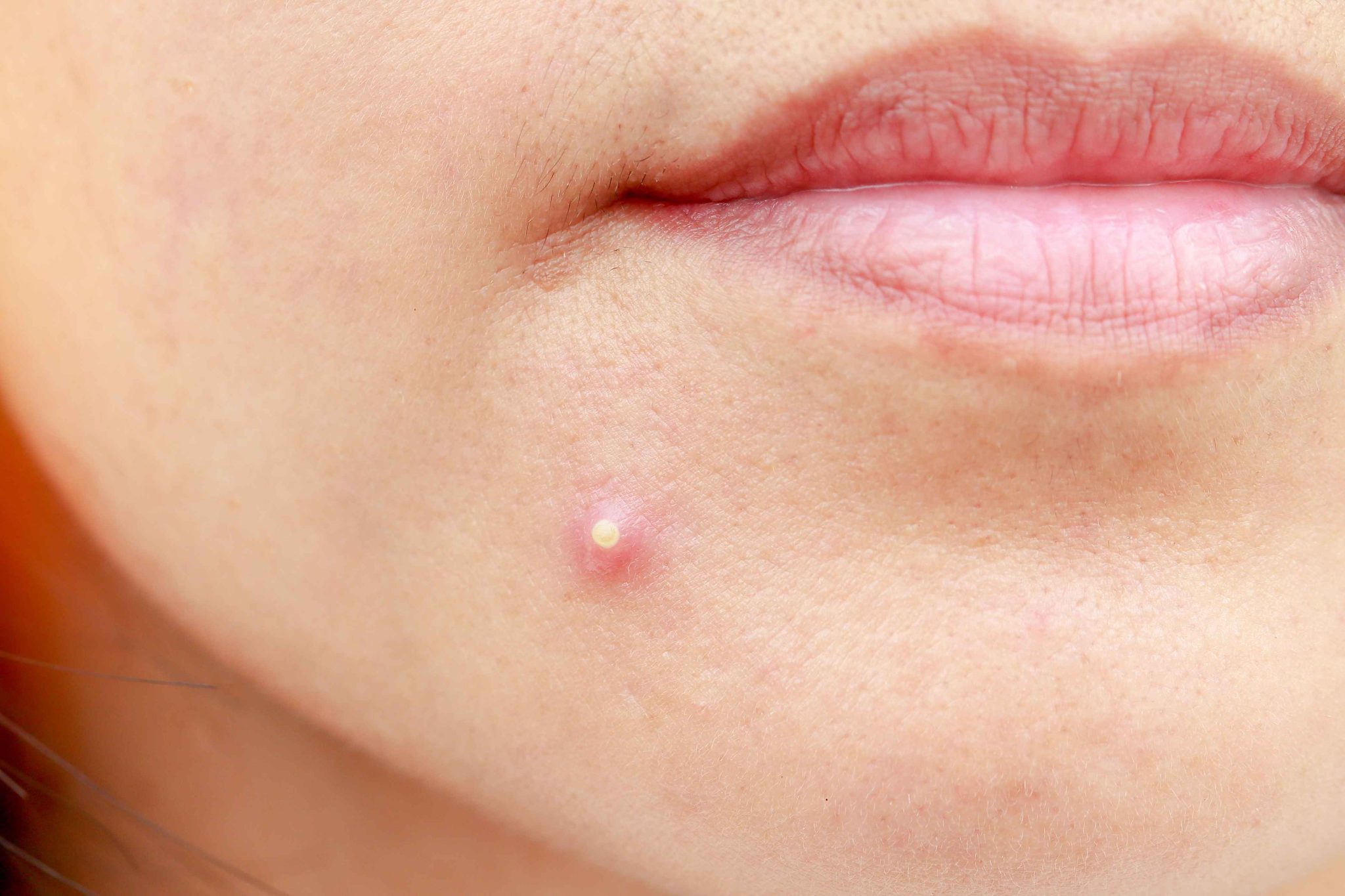 Should I Pop My Pimple? These 3 Key Points Can Help You Decide