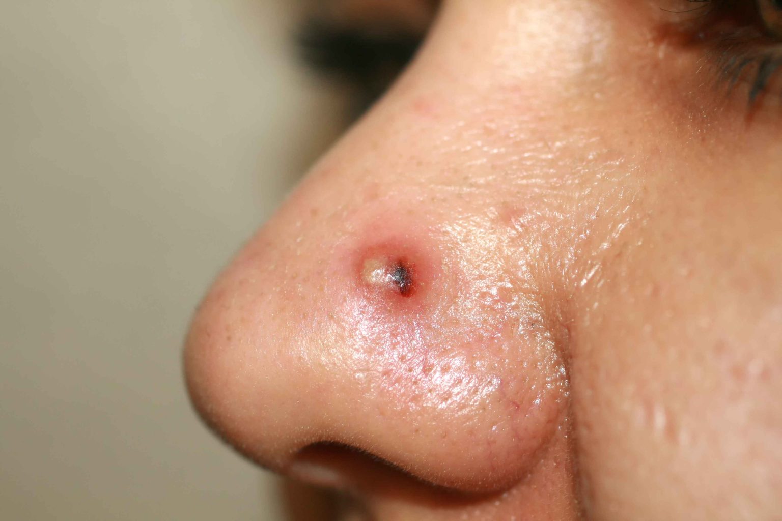 Should I Pop My Pimple? These 3 Key Points Can Help You Decide