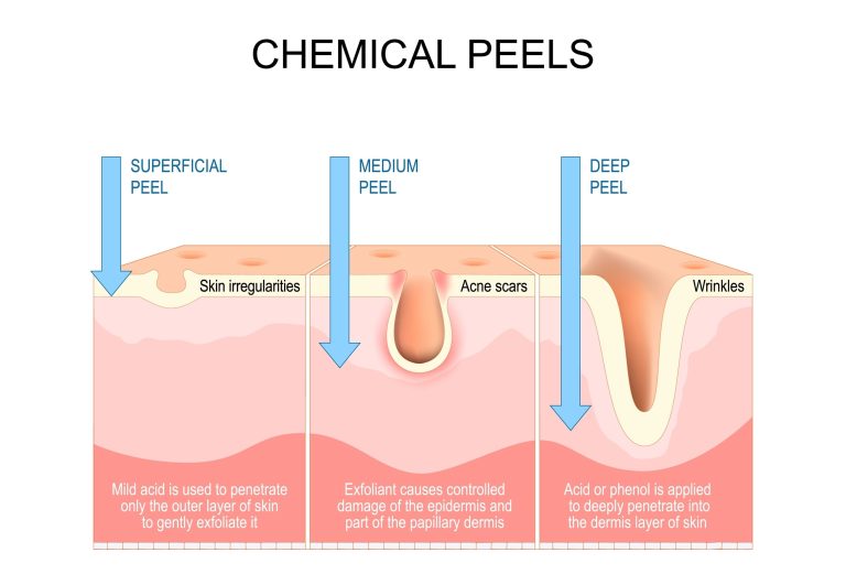 Chemical Peel 101: Everything You Should Know Before You Do It - OnSkin