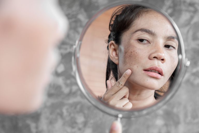 Uneven Skin Tone: How to Improve It - OnSkin